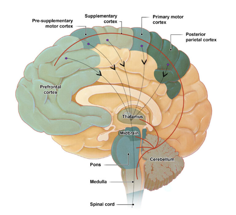 MS and Gait Deficit - PoNS